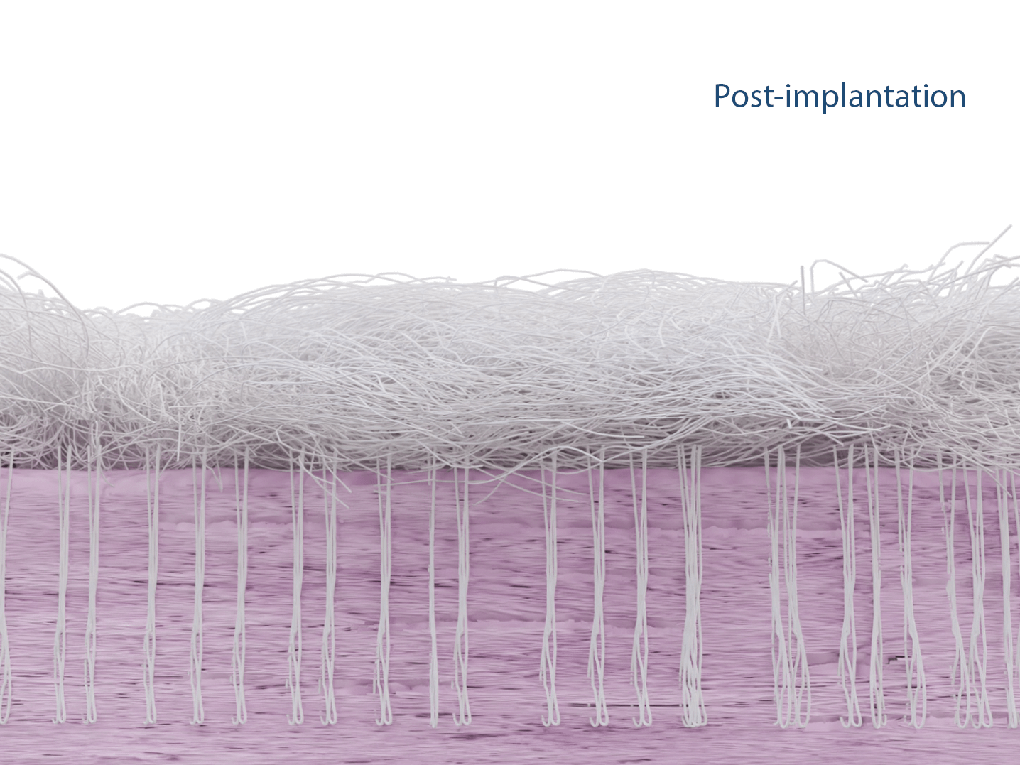 FiberLocker® System - ZuriMED Technologies AG